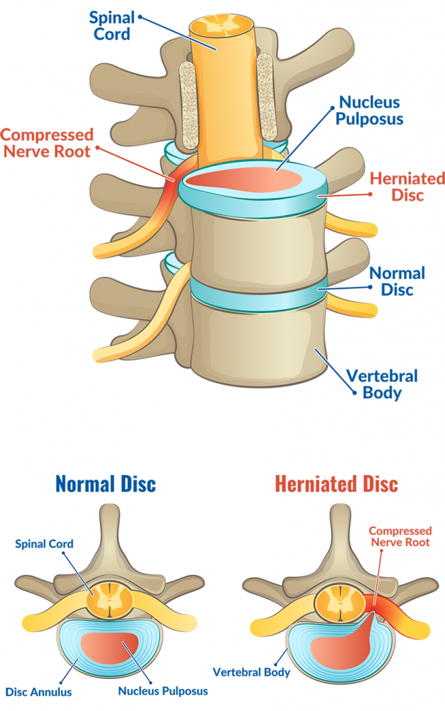 Herniated Disc Diagram - CORE Orthopedics
