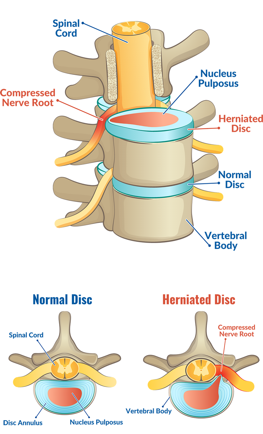 Herniated Disc Diagram - CORE Orthopedics
