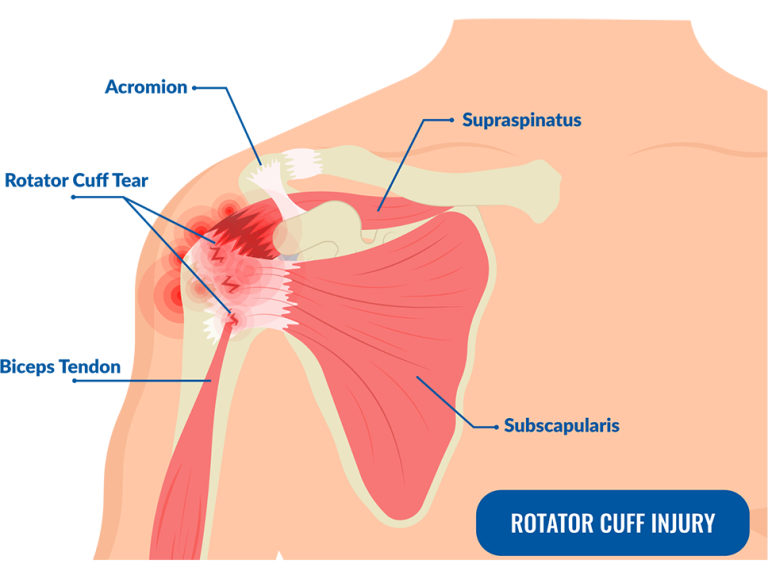 Most Common Pickleball Injuries and How to Avoid Them CORE Orthopedics