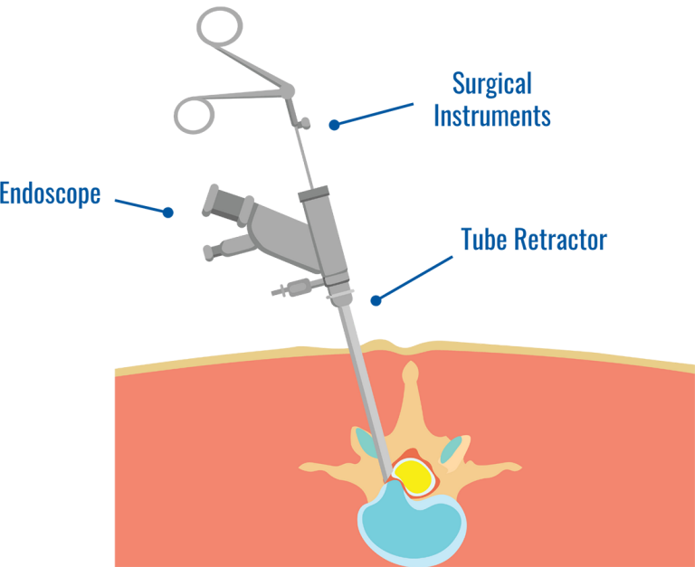What to Know About Endoscopic Surgery | CORE Orthopedics